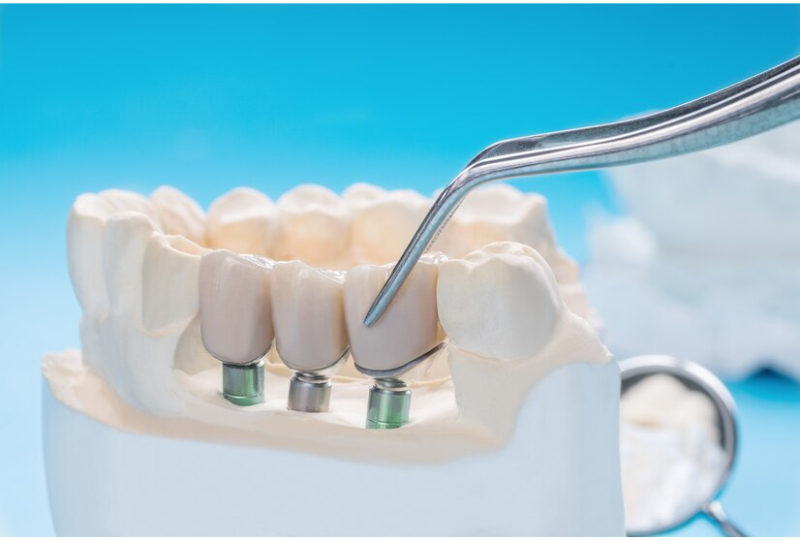 A Patient's Guide to Dental Crown Options: Types and Benefits!