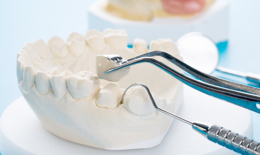 Unveiling Dental Crowns: Aesthetic and Functional Marvels