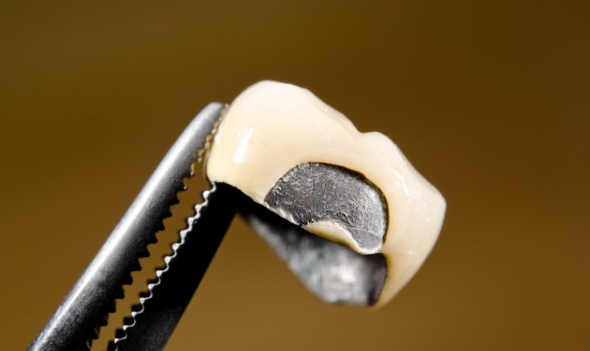 Loose or Broken Crown? Don't Panic! What to Do