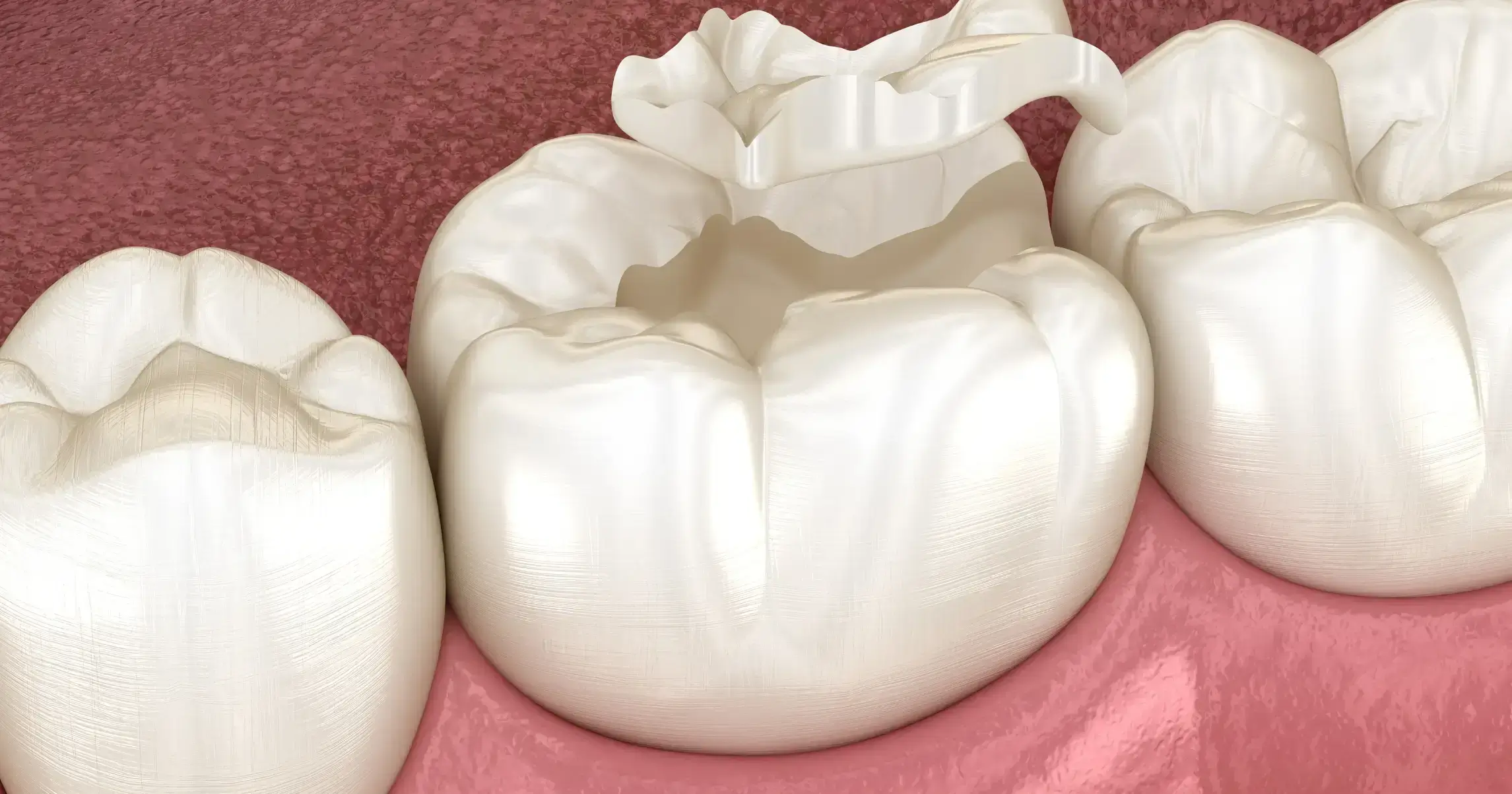 Cavity Prevention Made Easy with Dental Sealants