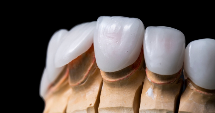 How Do Porcelain Veneers Work?